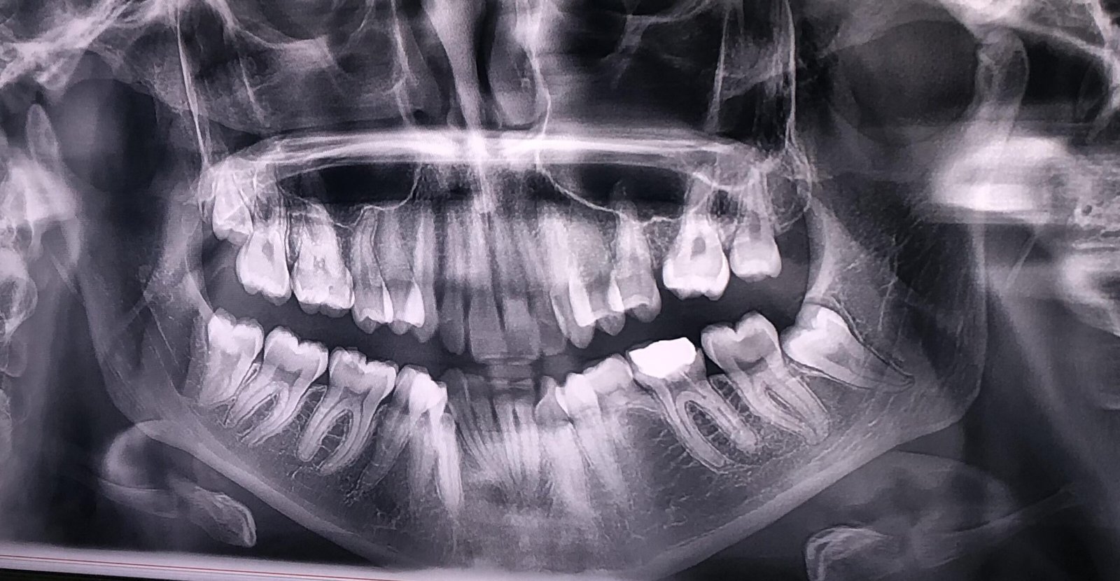Why Is My Tongue Numb Post-Extraction? Unveil Causes